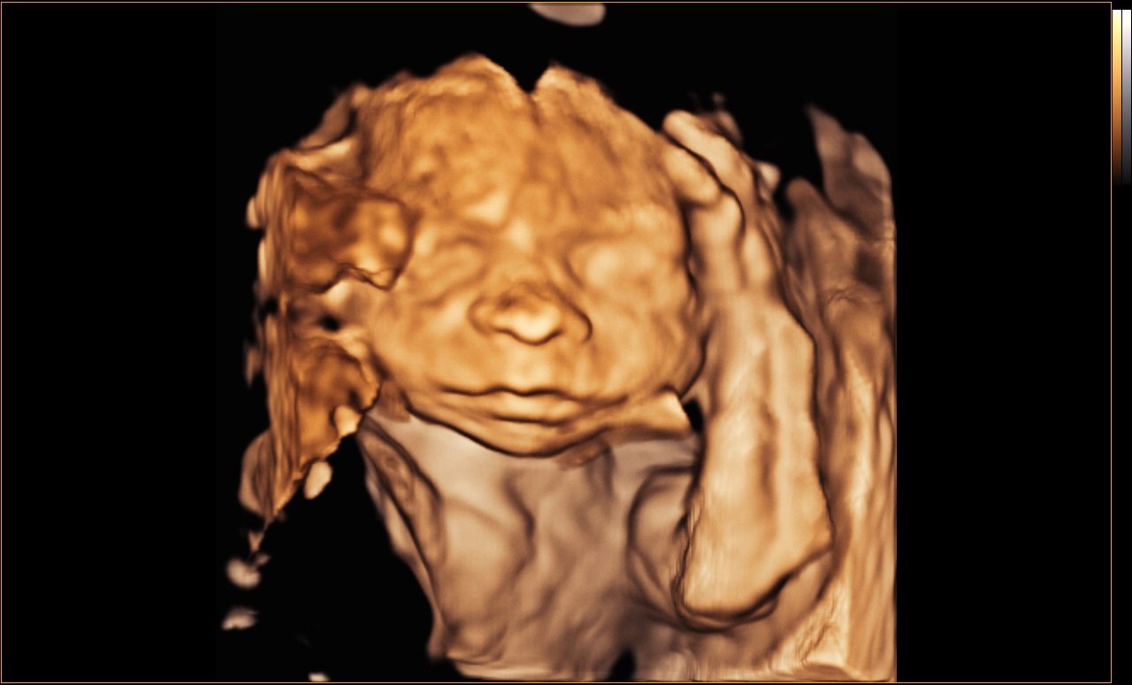 Teknik USG 4 Dimensi