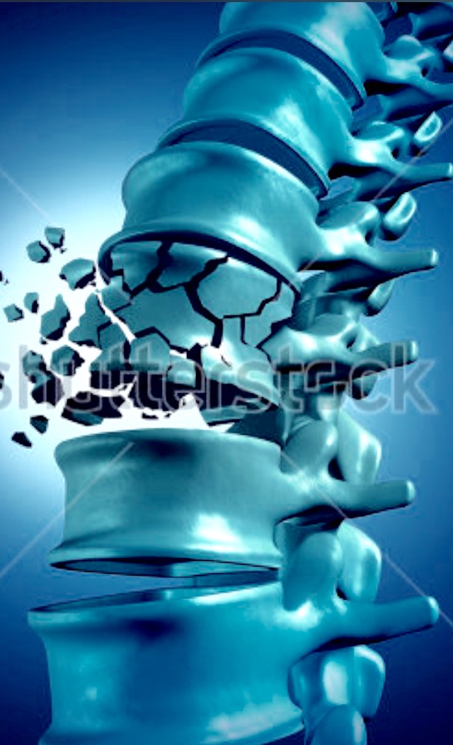 HealthSalus: OSTEOPOROSIS. WHEN BONES BECOME FRAGILE.