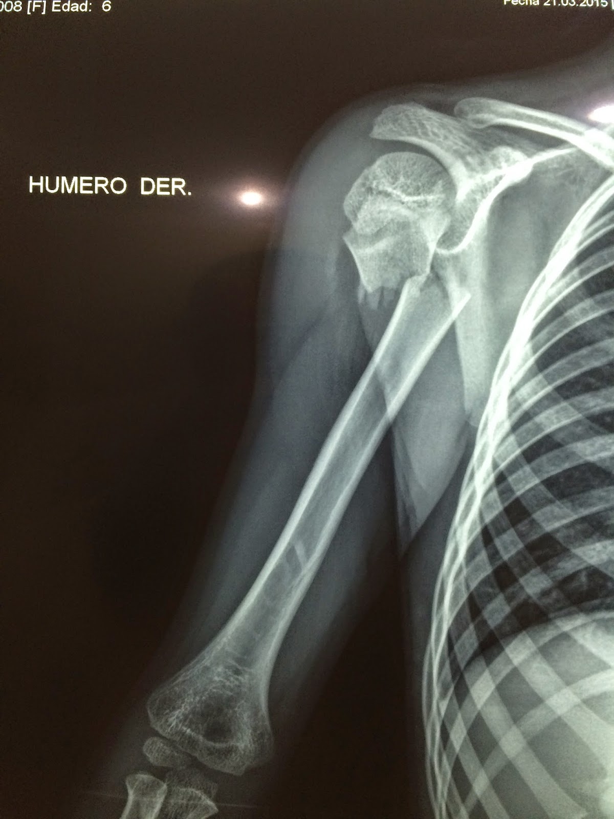 Ortopedia Pediátrica: Fractura de húmero proximal