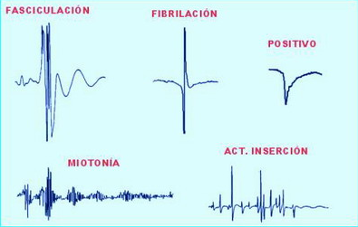 NEUROLOGÍA : ELECTROMIOGRAFIA