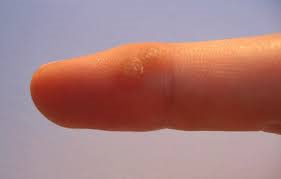 Best Way To Get Rid Of Warts Fast!: How To Get Rid Of Warts On Hand ...