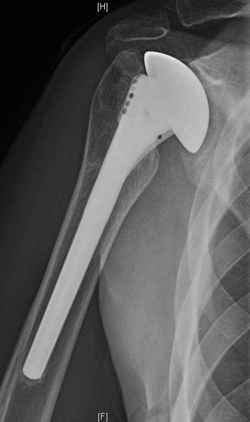 UW Shoulder and Elbow Academy: Shoulder arthroplasty infection with ...