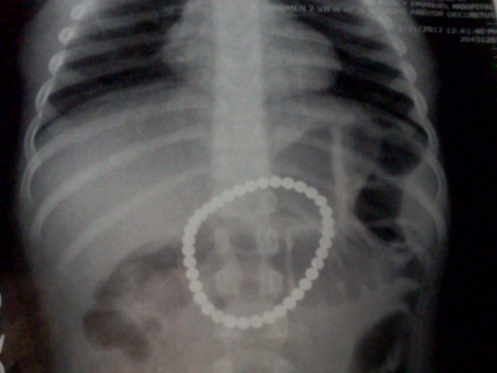 Fatos Surpreendentes: Criança engole 37 ímãs e deixa os pais pregados.