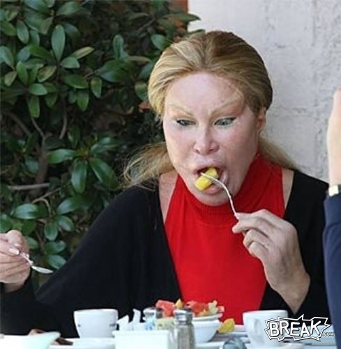 Carla Bruni's Botox Disaster