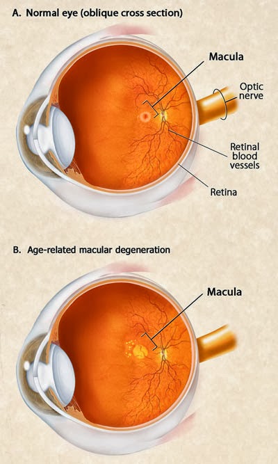 Macular Degeneration
