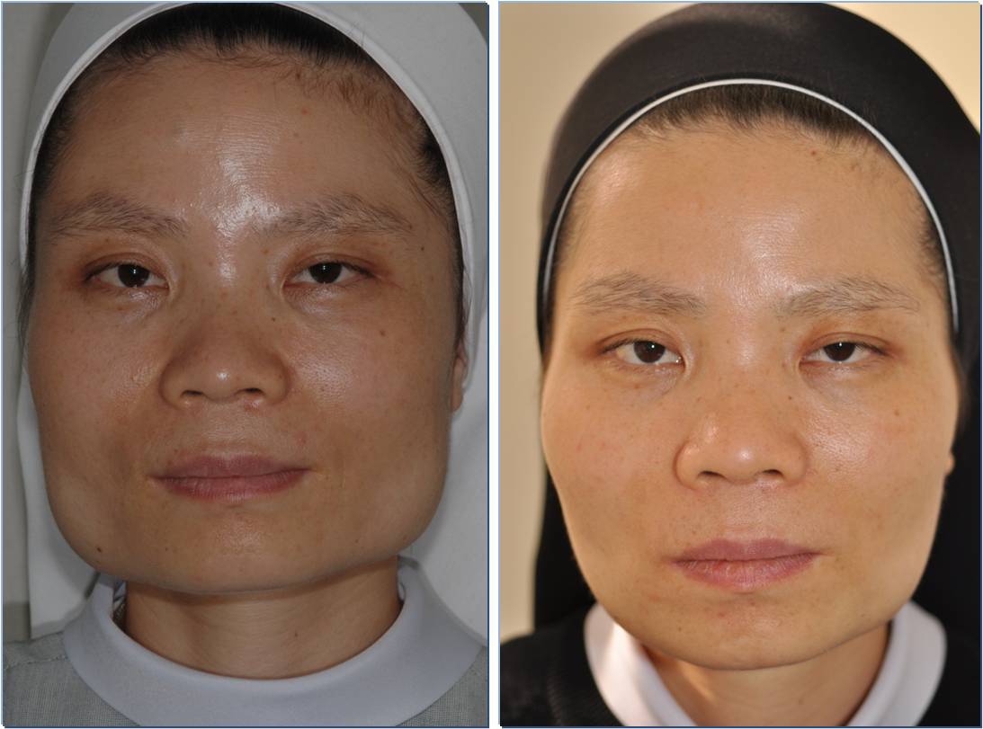 Dr.Han's Facial Contouring Clinic in Korea: Mandibular Angle Reduction ...