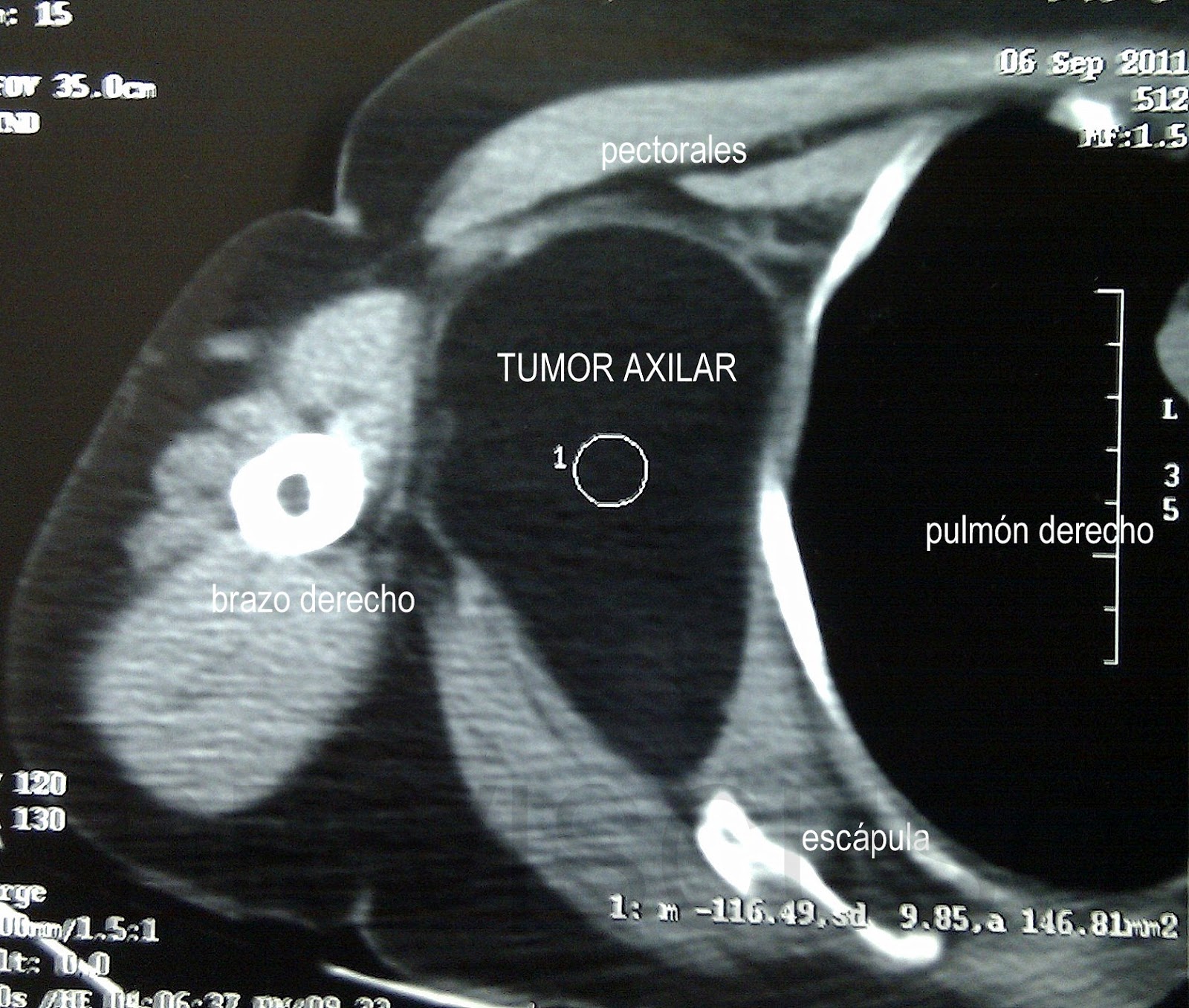 Que vi hoy: Masa axilar