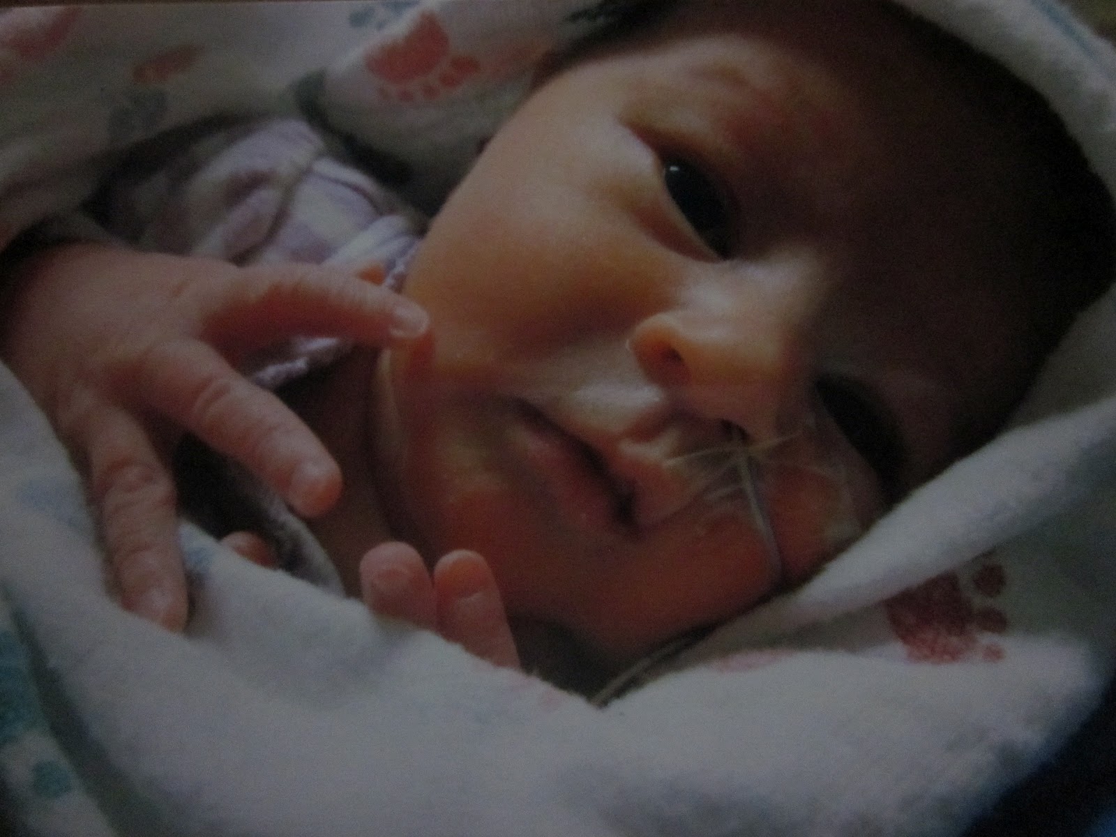 ECMO survivor: February 2012