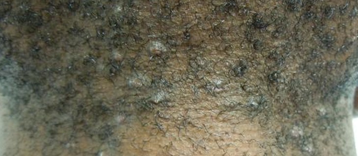 BLACK BUMPS: What's in the bump?
