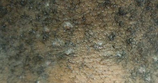 BLACK BUMPS: What's in the bump?