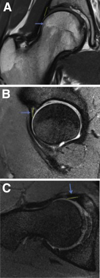 Revisiones_bibliográficas TyO_Web: La hipermovilidad articular ...