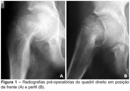 Epifisiólise femoral proximal