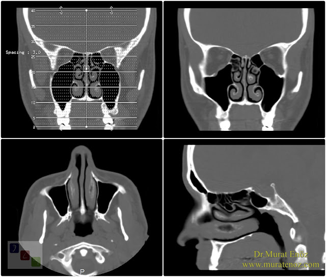 Why Turbinates Regrow / Hypertrophied Again After Radiofrequency Volume ...