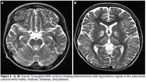 Medical Treatment Pictures-for Better Understanding: Kearns Sayre Syndrome