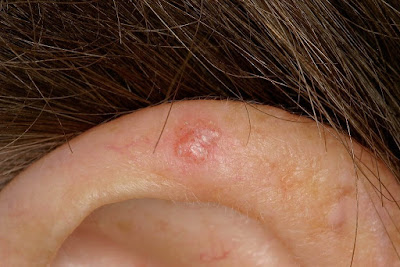 Dermatology For Dentists and Dental Students: Ears