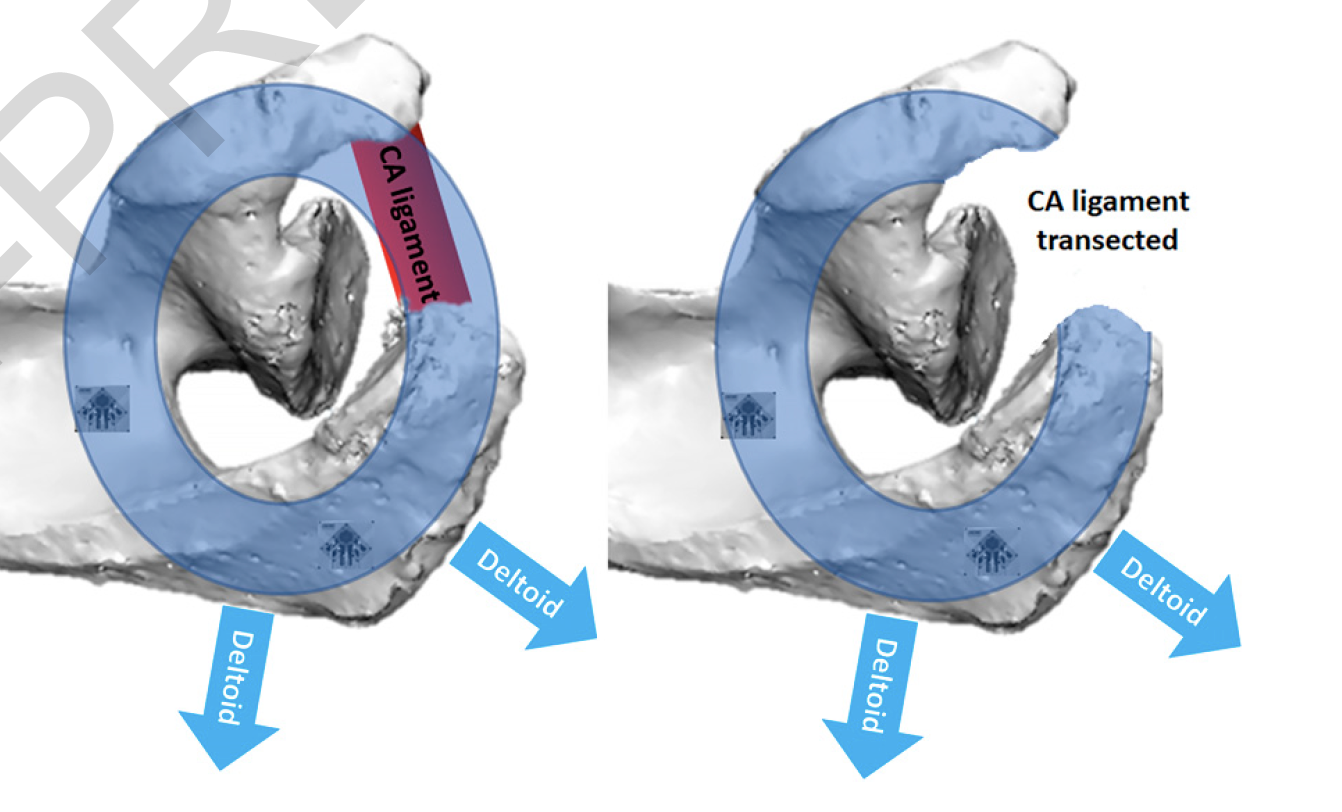 UW Shoulder and Elbow Academy: Don't cut the coracoacromial ligament ...