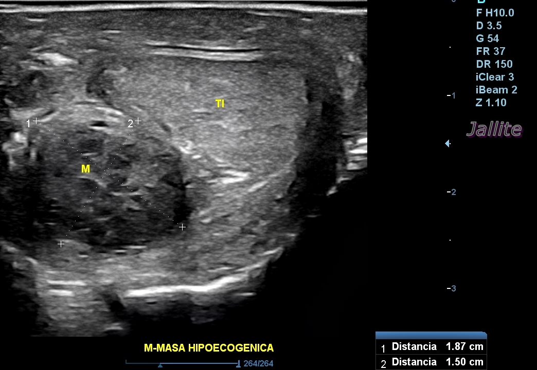 Tumor Extratesticular & Absceso Bolsa Escrotal