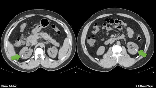 Ultimate Radiology : Calyceal Diverticulum