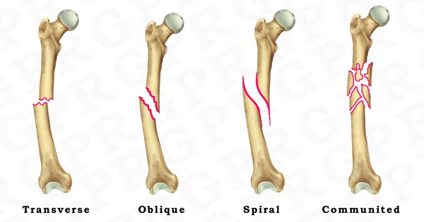 Trinity Orthopedics: Fracture Classification