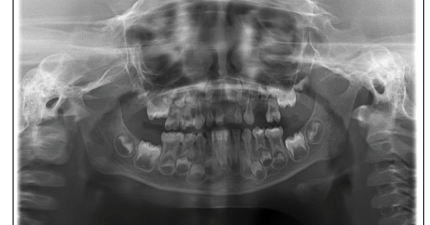 Non Syndromic Form of Bilateral Bimaxillary Bull Teeth- A Case Report ...