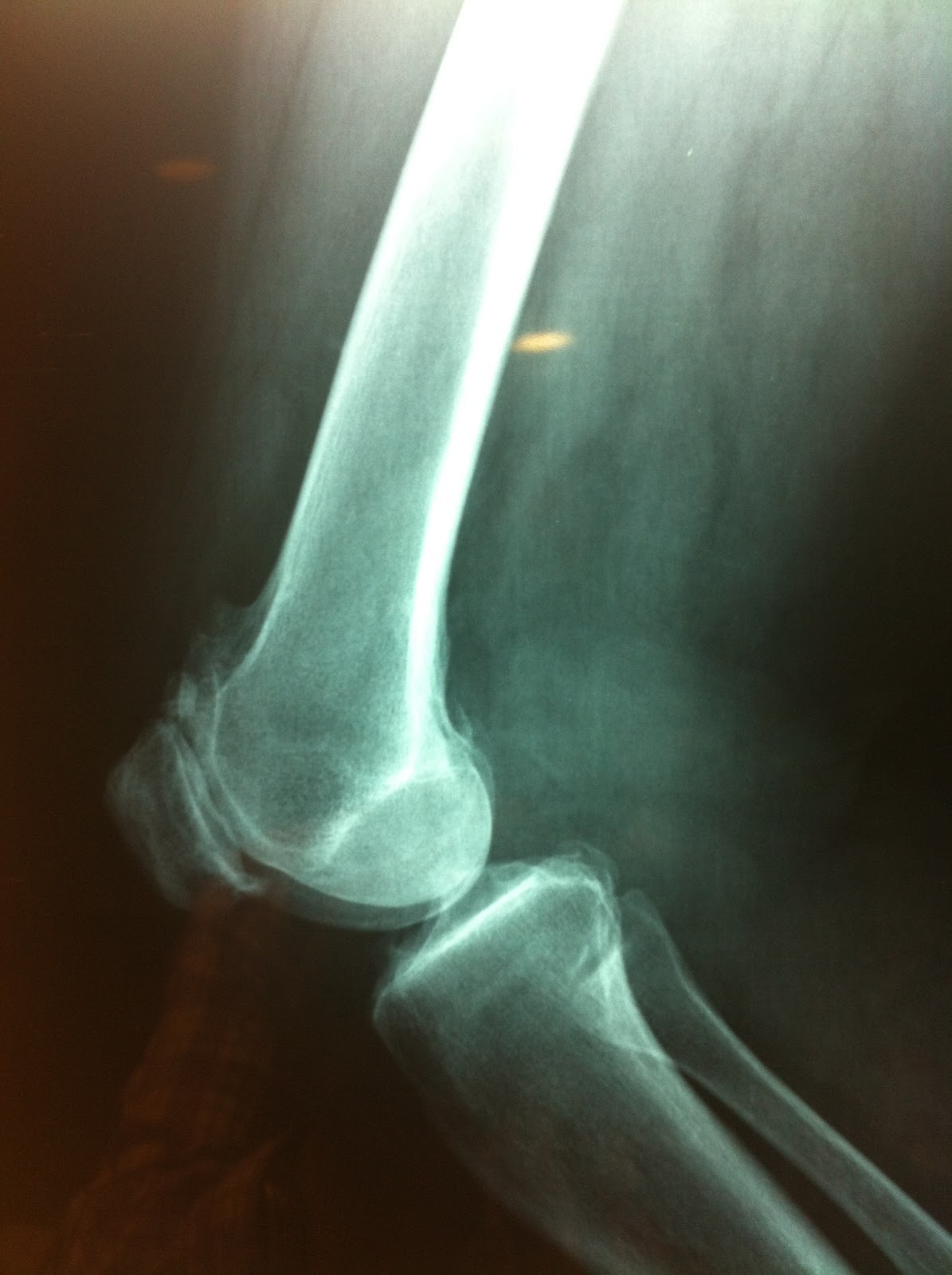 Reumails. Reumatología al día: Artrosis femoropatelar avanzada ...