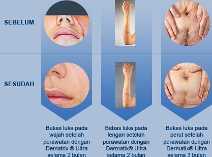 Chooyaya Secret Garden : Dermatix Ultra Untuk Menghilangkan Parut Kesan ...