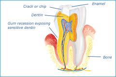 Dentin Hypersensitivity ~ Dental Vision