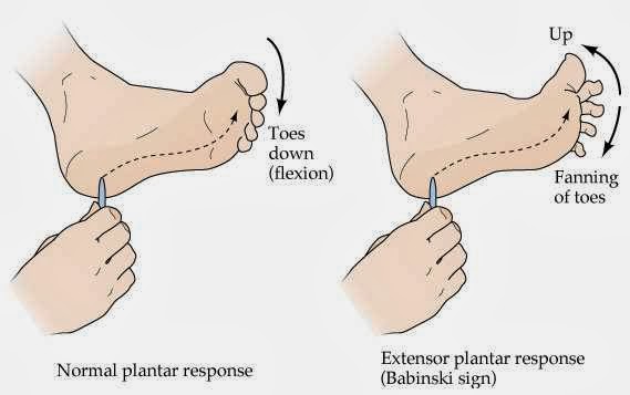 Reflex, babinski; Babinski Reflex; Extensor Plantar Response ...