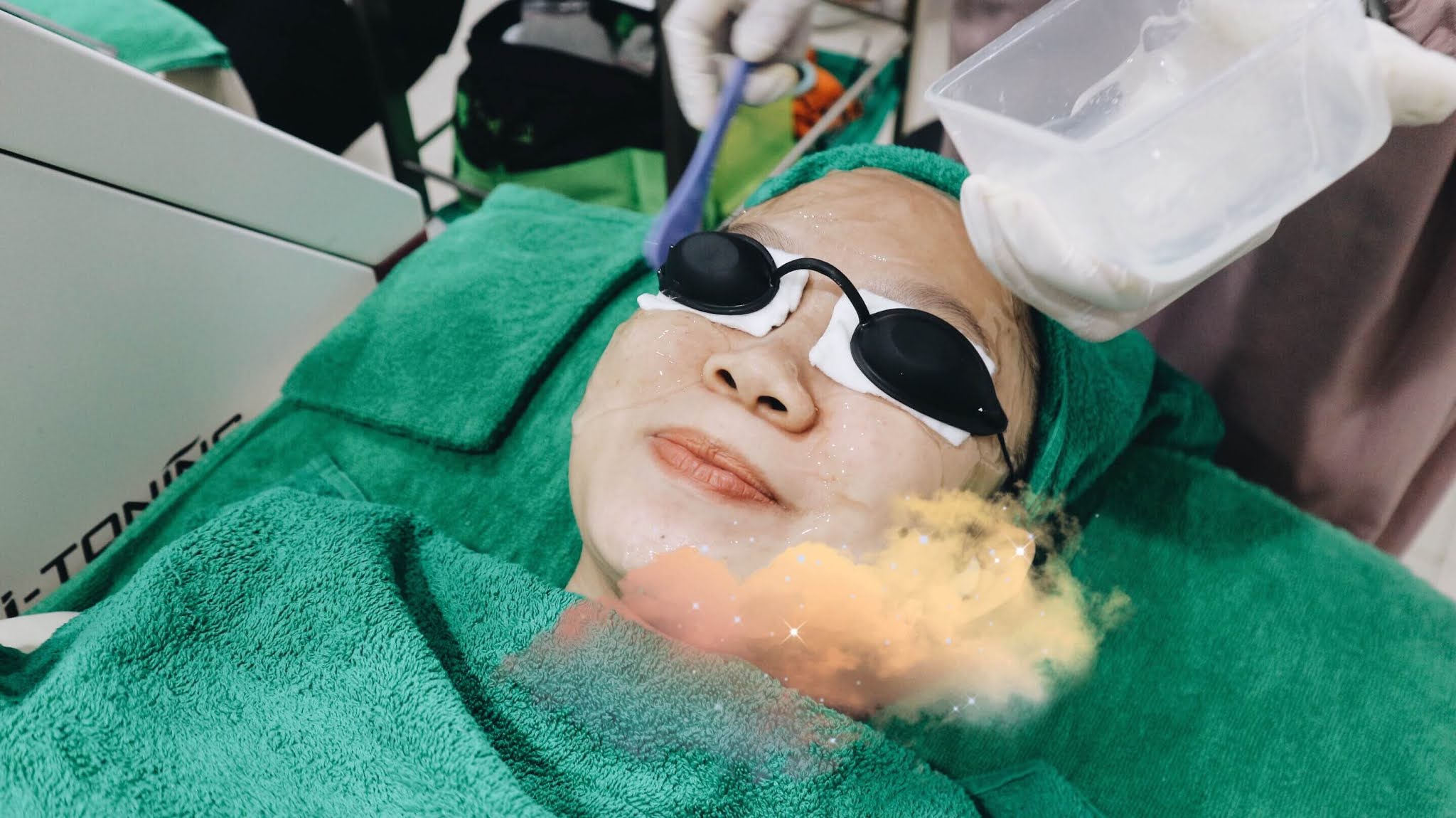 Perawatan Intense Pulse Light (IPL) di Aishaderm Jogja - Marlina