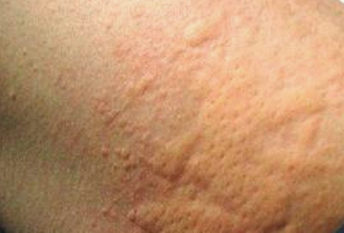 7 Penyebab Gatal Pada Kulit, beserta Tanda-Tandanya