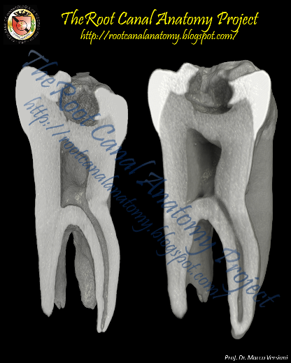 The Root Canal Anatomy Project: Four-Rooted Maxillary Second Molars