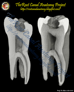 The Root Canal Anatomy Project: Four-Rooted Maxillary Second Molars