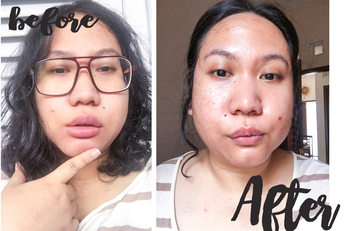 [REVIEW] Treatment Derma Face Therapy (DFT) Acne Di NMW Skin care ...