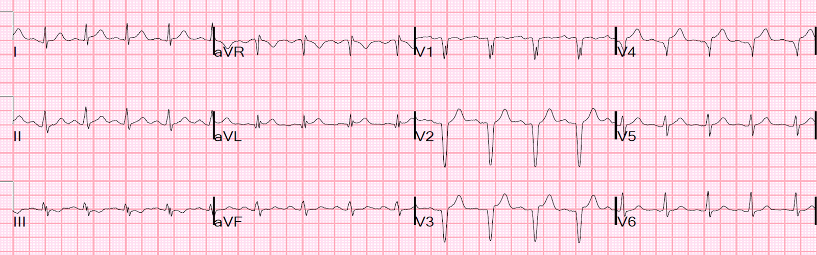 Dr. Smith's ECG Blog: Subtle Anterior STEMI Superimposed on Anterior LV ...