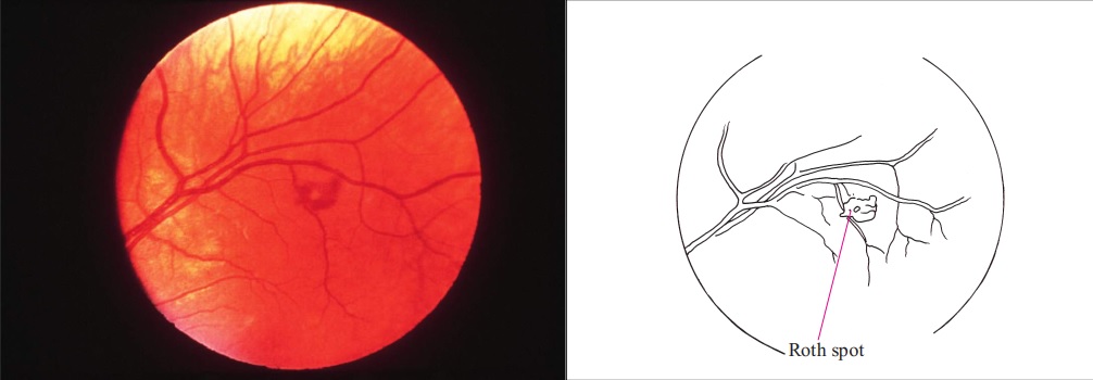 [Emergency] Atlas of Roth spots | Free Medical Atlas