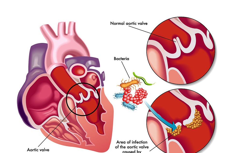 Nurse Advocate: Heart Infections: Endocarditis