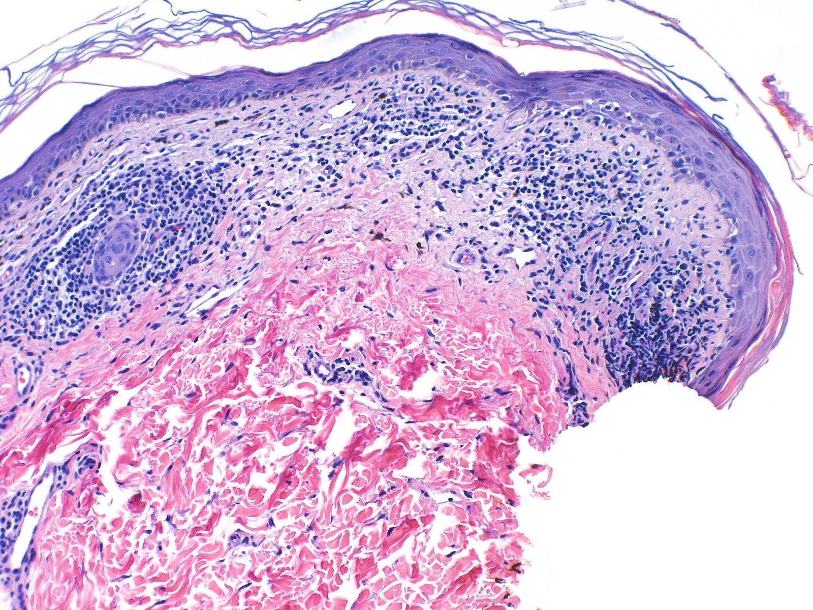 VIRTUAL GRAND ROUNDS IN DERMATOLOGY 2.0: A Case for Diagnosis