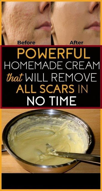 Make This Homemade Cream To Remove Scars And Refresh Your Skin In Just ...