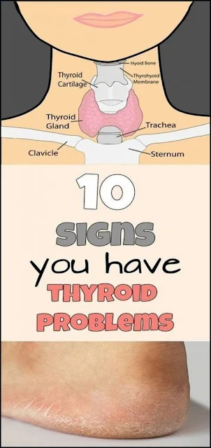 10 Signs You Have A Thyroid Problem And 10 Solutions For It - Healthy ...