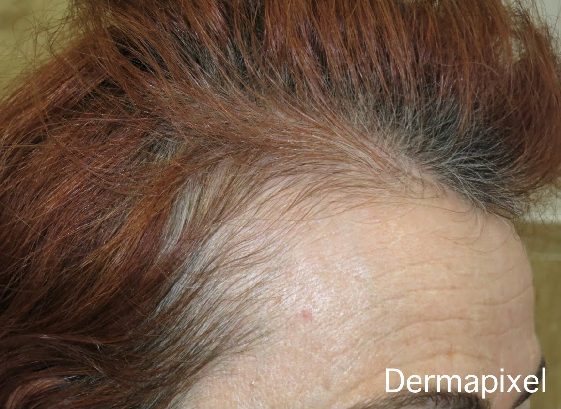 Dermapixel: marzo 2021