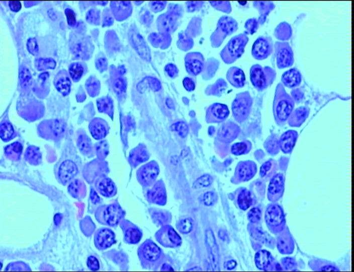 Exordios Clínicos: * Enfoque del paciente con Mieloma Múltiple (MM)