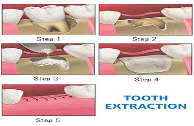dental x ray: Simple and Surgical Extractions