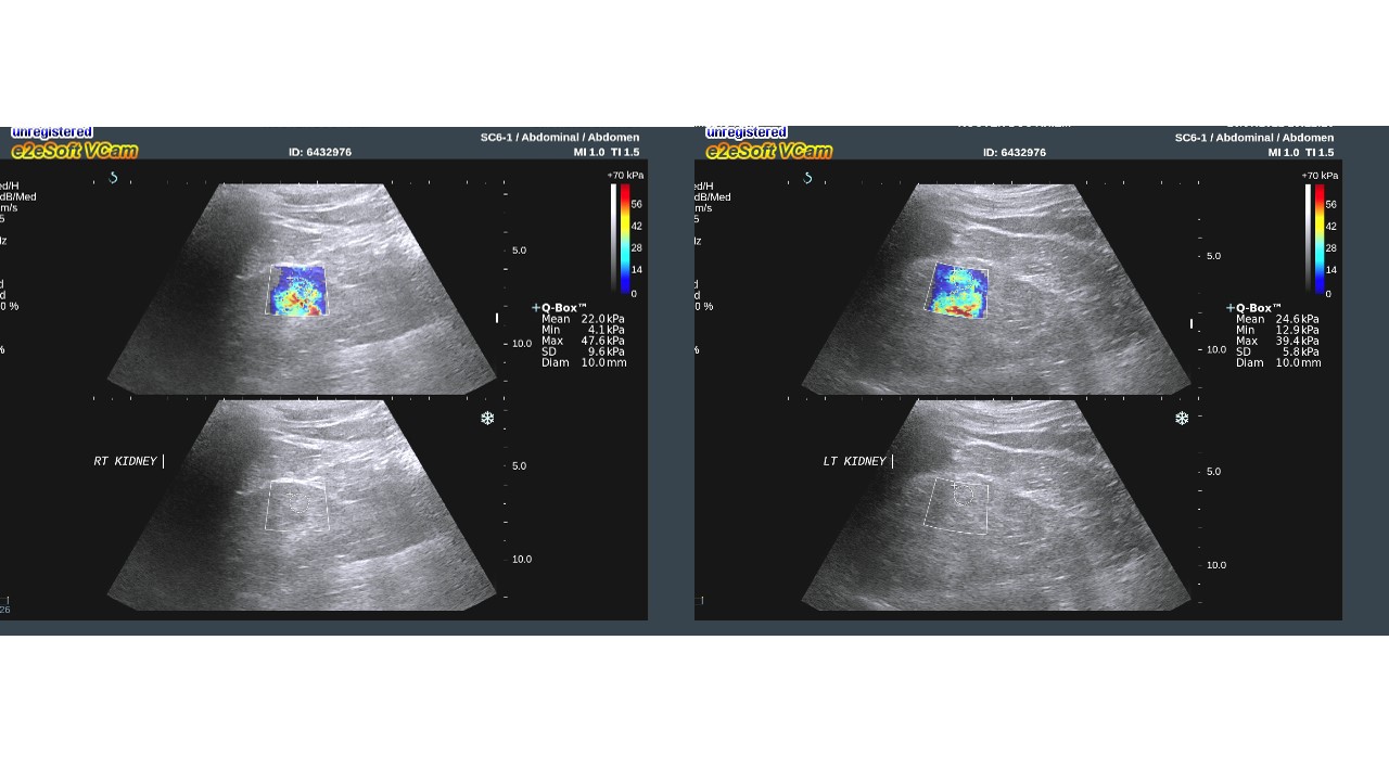 VIETNAMESE MEDIC ULTRASOUND: CASE 614: ELASTOGRAPHY ULTRASOUND for a ...