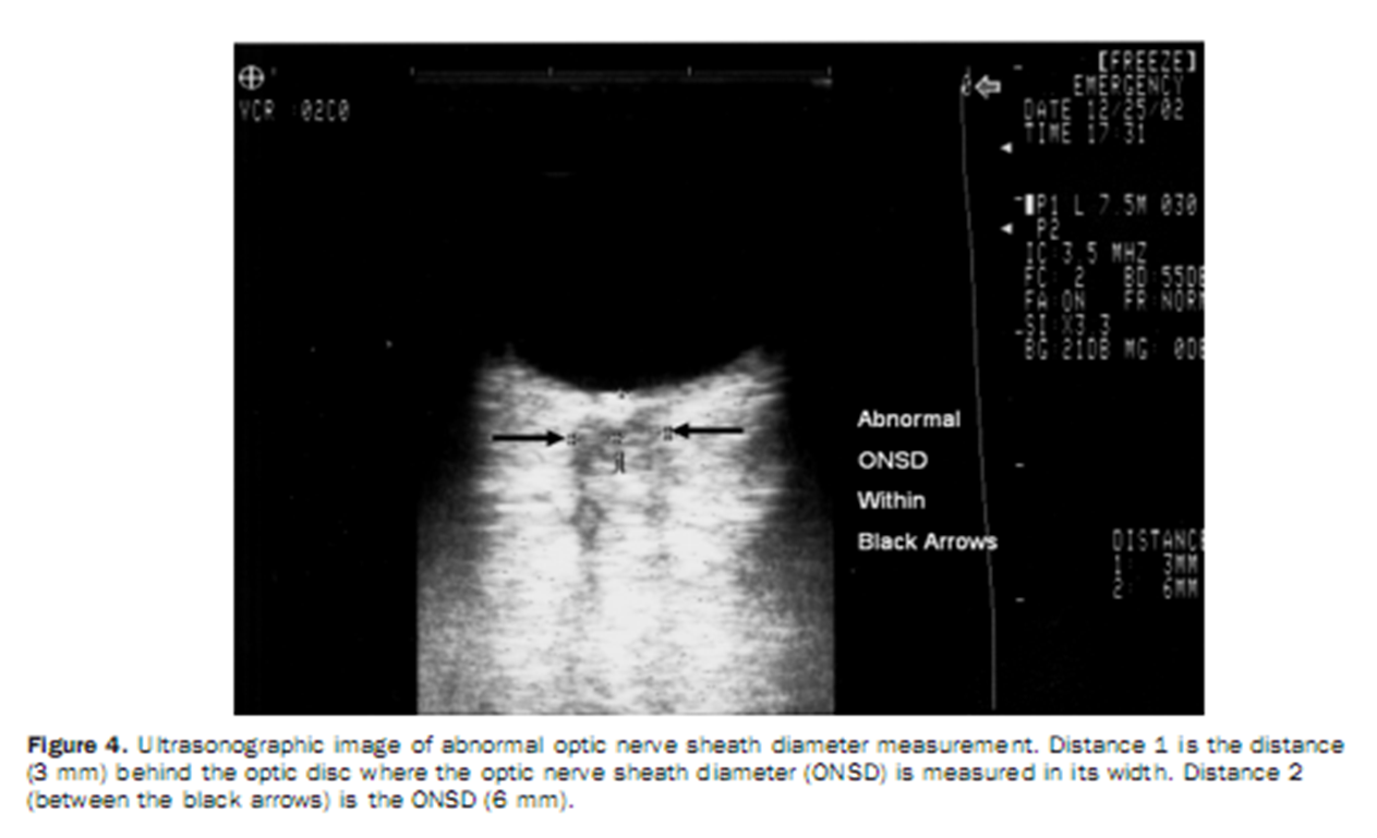 BÀI SOẠN VỀ SIÊU ÂM CHẨN ĐOÁN: ONSD ULTRASOUND TIÊN ĐOÁN TĂNG ÁP NỘI SỌ