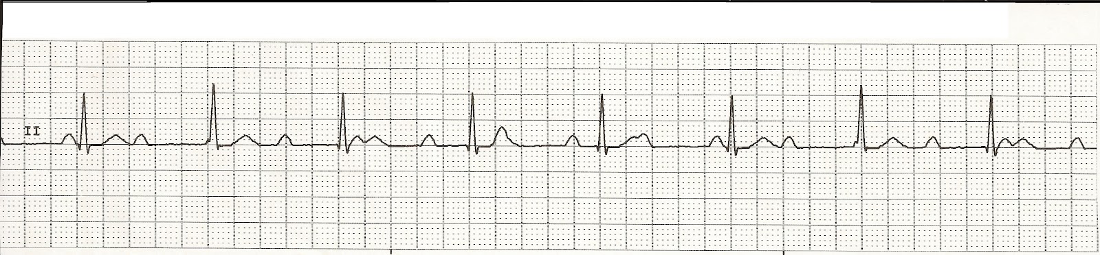 EKG Rhythm Strip Quiz 52: Heart Blocks