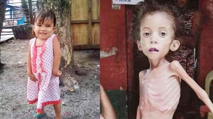 6-anyos na bata, naging buto't balat dahil sa mga bulate sa tiyan ~ e ...