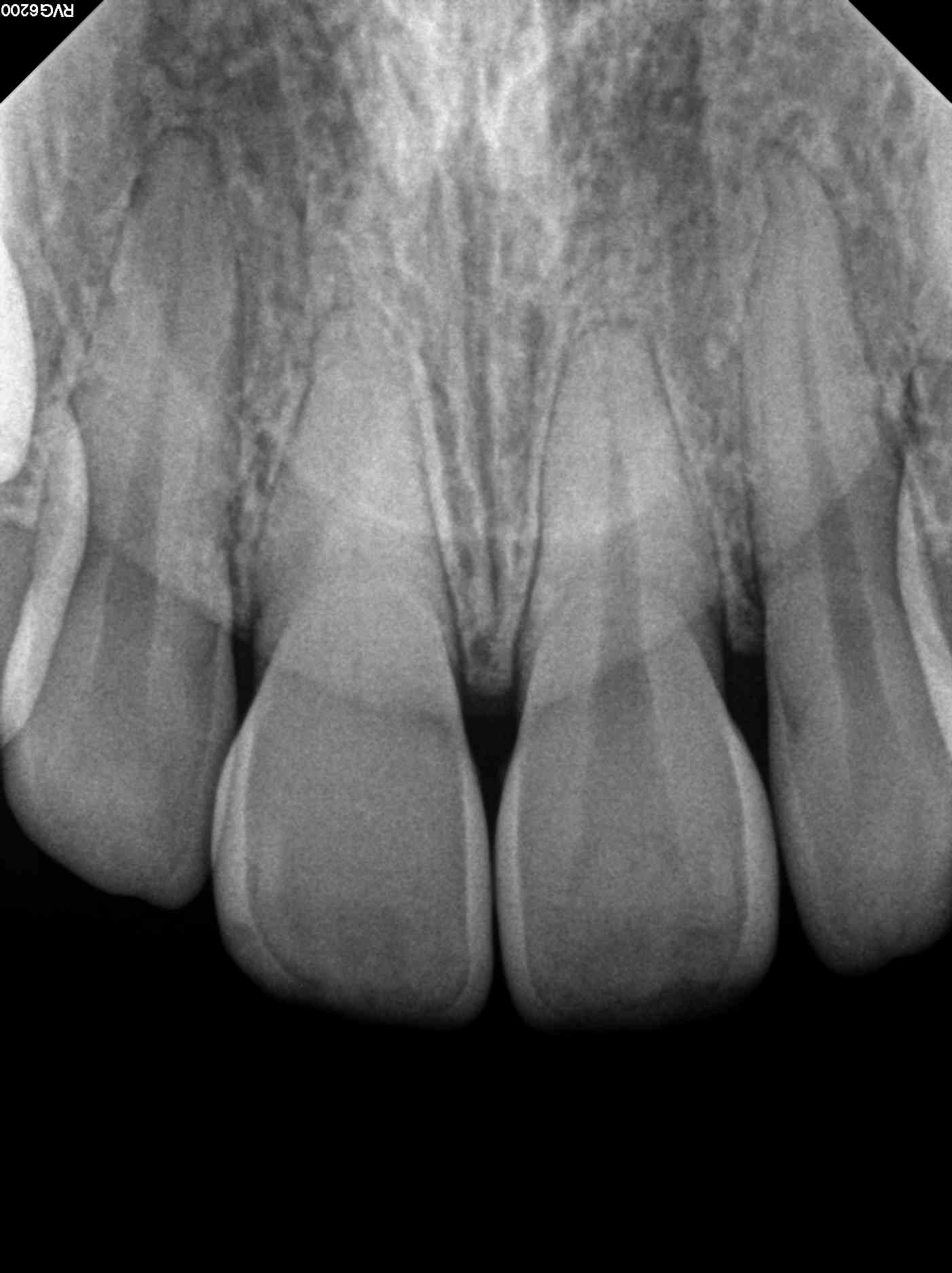 TRATAMIENTO DE CONDUCTOS: 1.1 calcificado. Blanqueamiento interno
