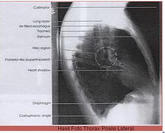 DIAMOND: TEKNIK RADIOGRAFI THORAX