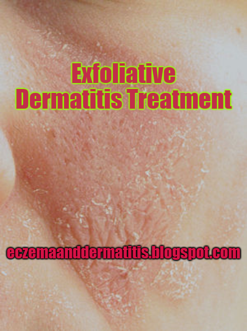 Exfoliative Dermatitis Treatment - Eczema and Dermatitis