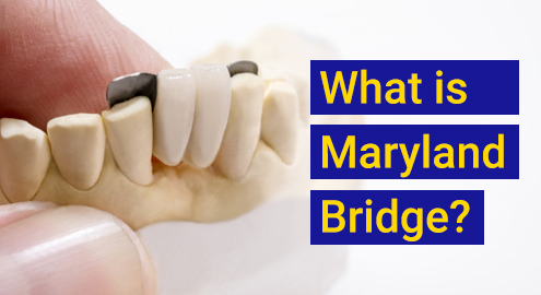 Harris Park Dental Lab in Australia: Maryland Bridge in NSW, Parramatta ...